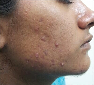 Acne rosacea in 2nd decade of life and its homoeopathic management